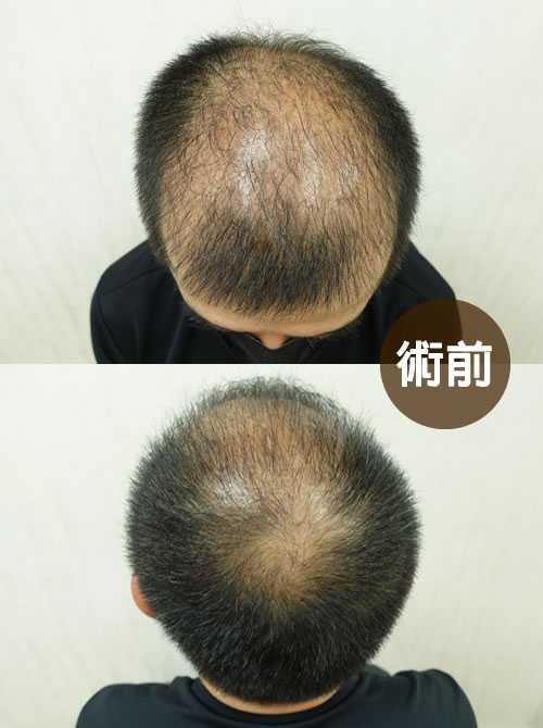 COMBO High Density Hair Transplant Taiwan Hair Transplant